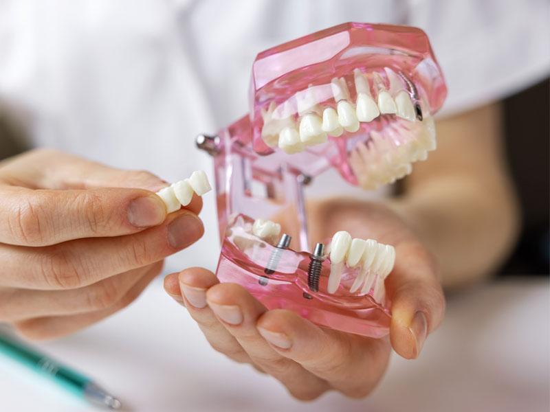 Dental Implants & Prosthetics | Alliance Dental Coldbrook